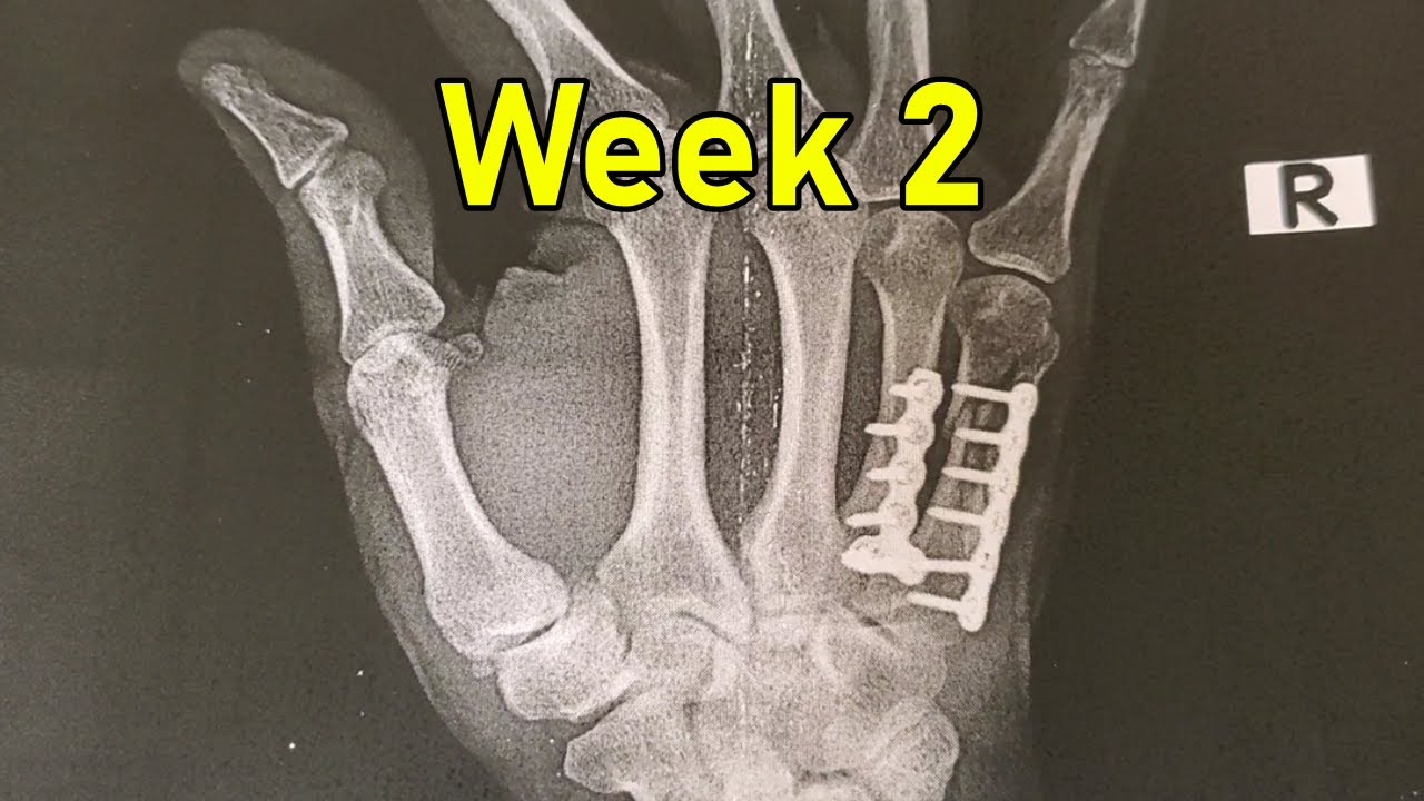 Week 2 Soft Callus 🤕🖐🦴 @JamesBondJB007 - YouTube