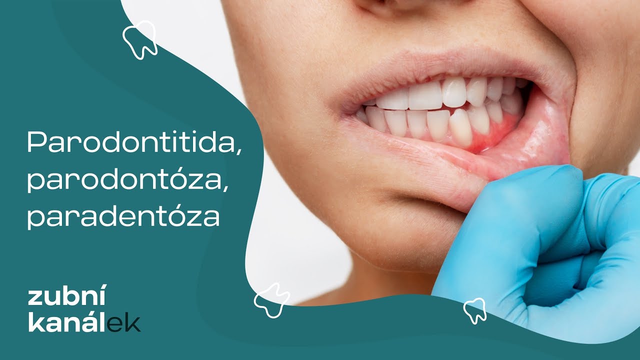 Parodontitida, parodontóza, paradentóza - YouTube