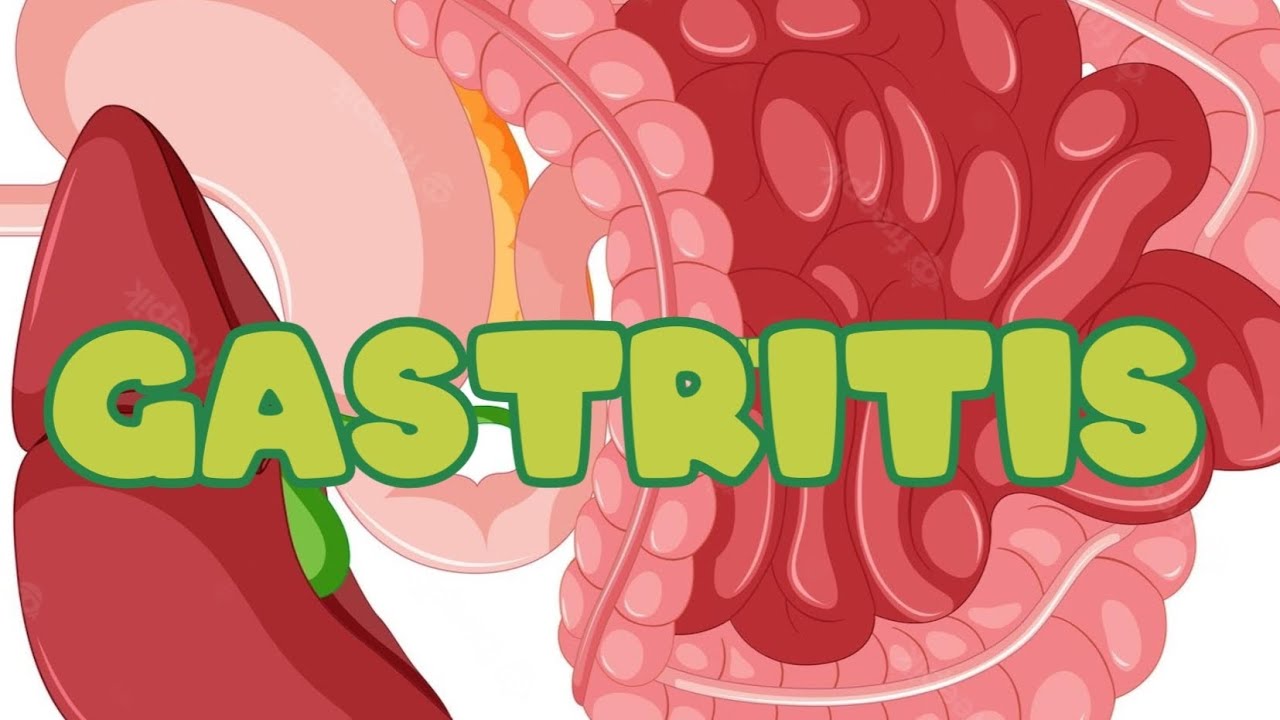 Gastritis | Acute and Chronic gastritis | GIT pathology - YouTube