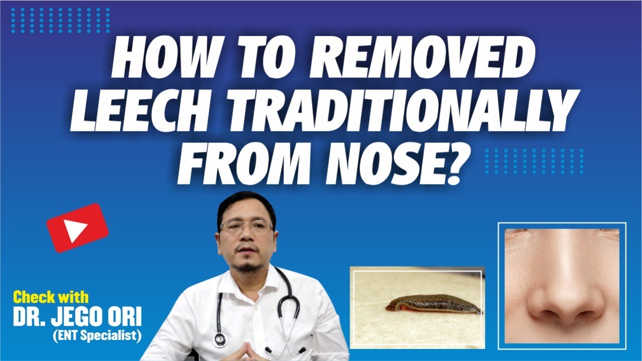 HOW TO REMOVED LEECH TRADITIONALLY FROM NOSE? Dr. Jego Ori - YouTube