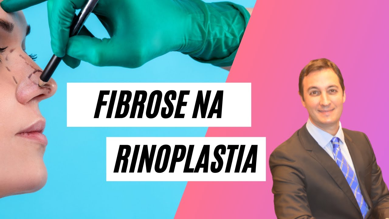 Fibrose na rinoplastia - YouTube