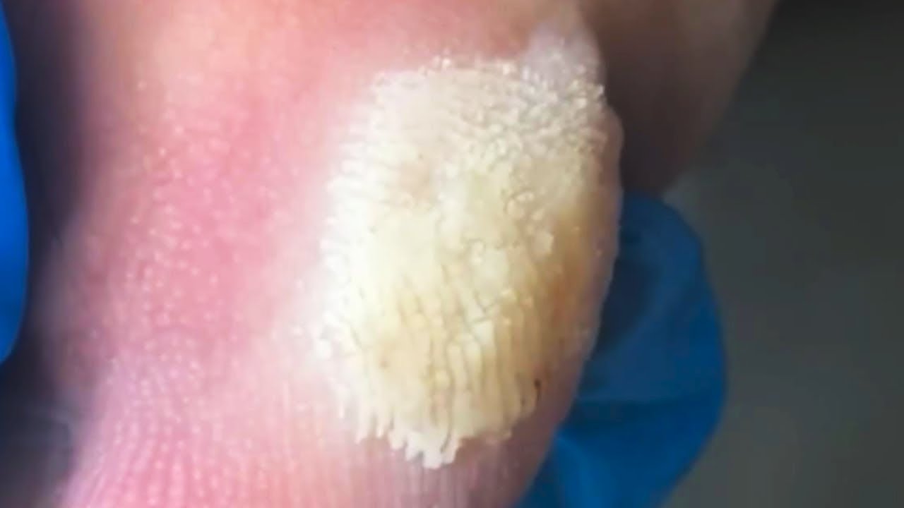 Give The Toes A Comprehensive Cleaning, Peel Off Dead Skin And Ingrown ...