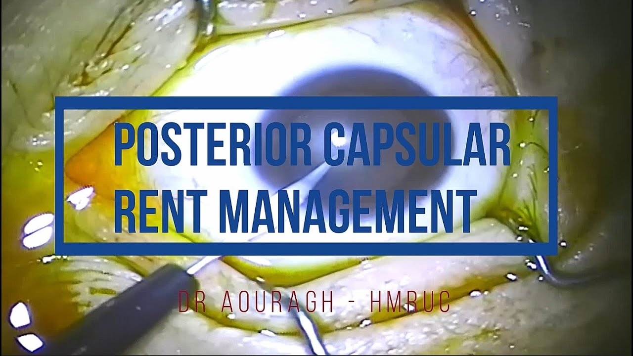 Posterior capsular rent management in a cataract surgery - YouTube