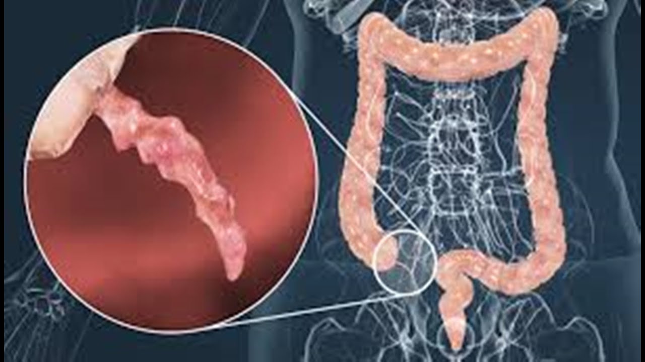 Dores do lado direito depois da cirurgia de apendicite? Apendicite pode ...