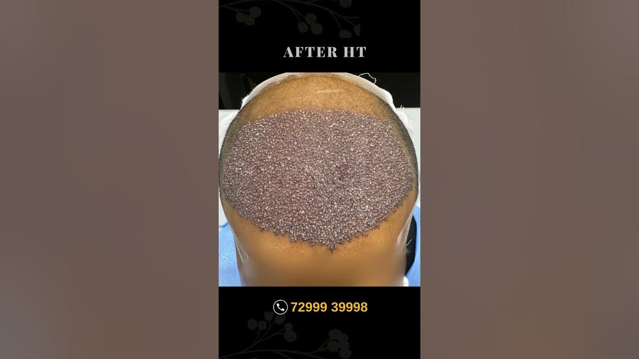 Best Treatment For Hair Loss Best Hair Loss Doctor Near Me La Hns