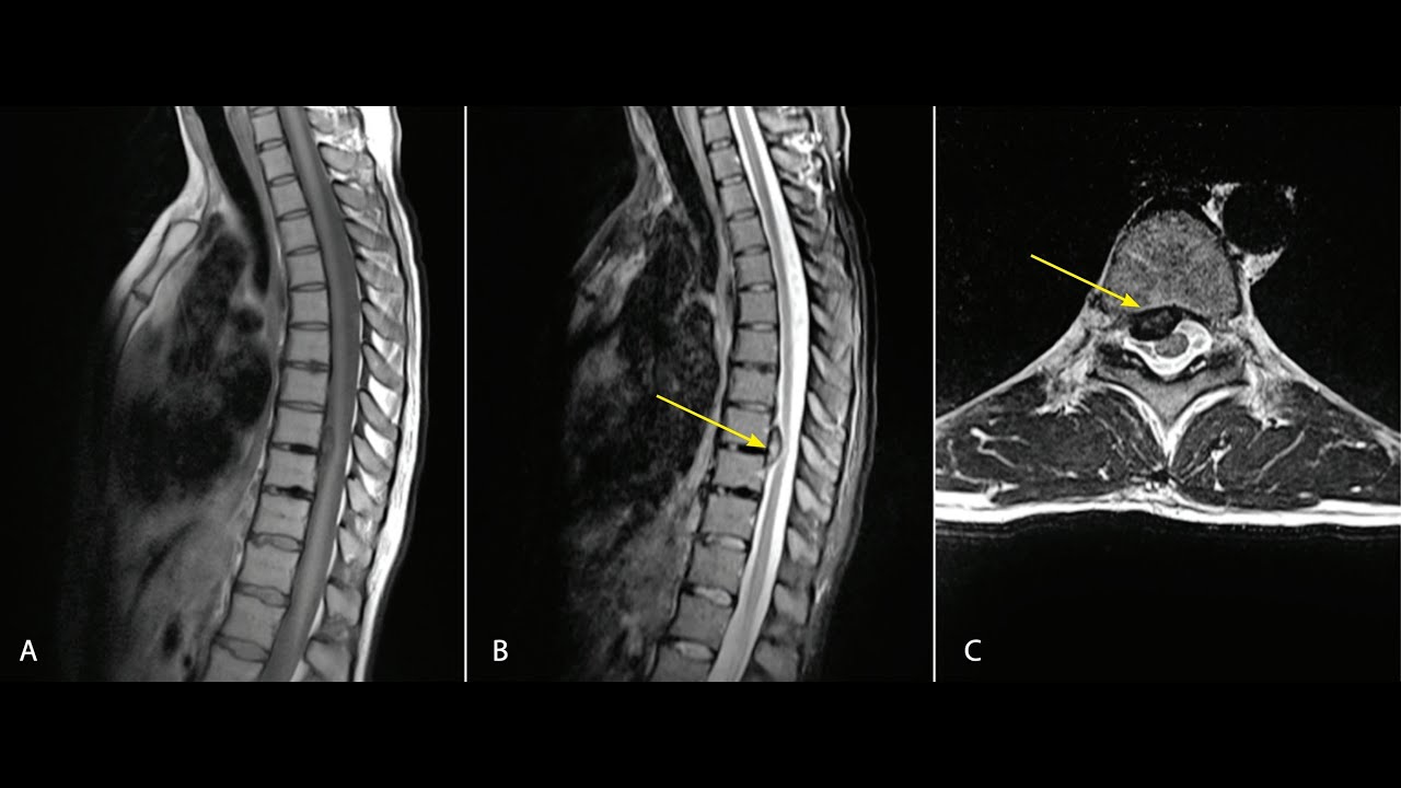 Torakal disk herniasyonları - Thoracic disc herniation - YouTube