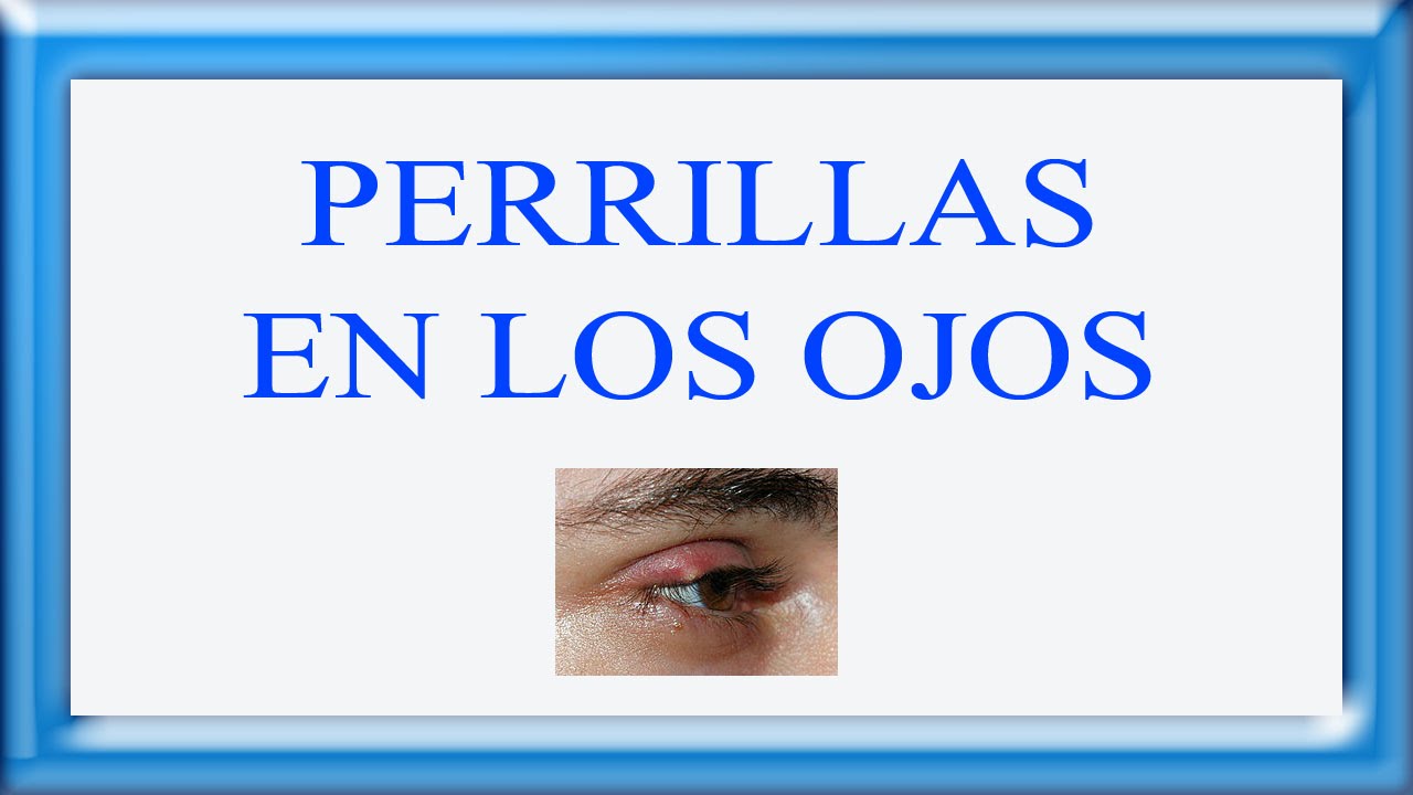 Perrillas en los ojos u orzuelo - YouTube