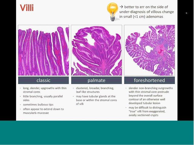 Tubular Polyp Tubular Adenomas: How Serious Are They? Facty Health