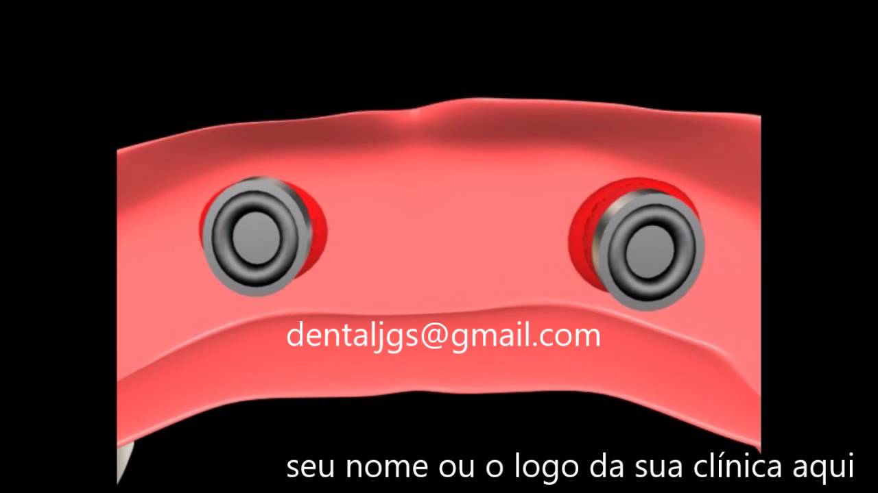 Overdenture com O rings (Pacote Clinic) - YouTube