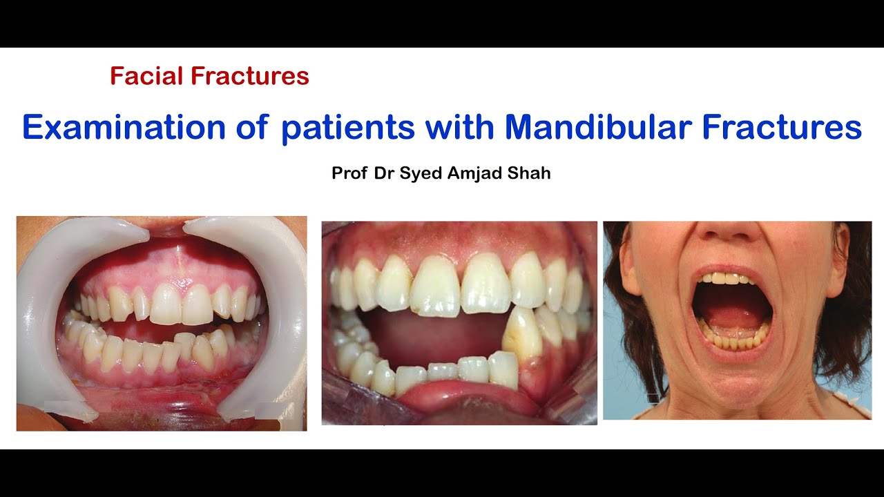 Examination of patients with mandibular Fracture | Oral & Maxillofacial ...