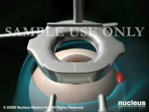 3D Medical Animation LASIK Eye Surgery for Nearsightedness.flv - YouTube