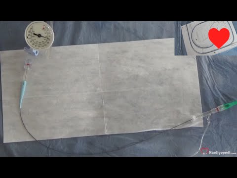 Over-the-wire sistemin çıkarılması(nanto yöntemi)