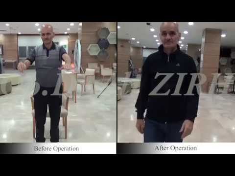 Gülağa QASIMOV / Before and After Surgery Parkinson's Treatment DBS in Turkey