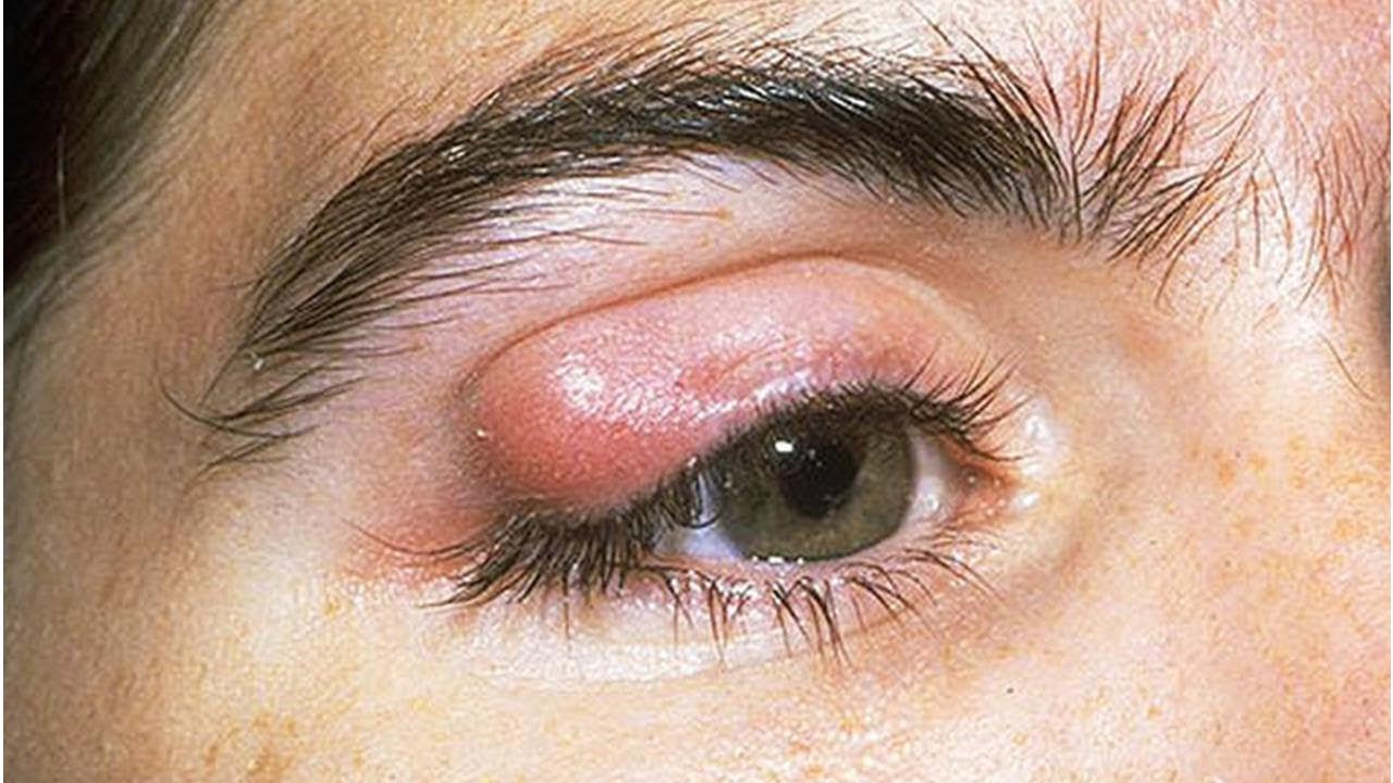 Common Causes of Heaviness of Your Eyes - YouTube