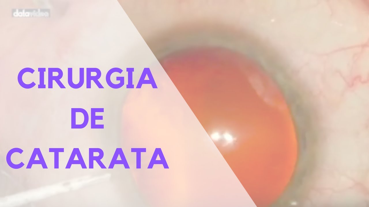 Cirurgia de Catarata (Nuclear 1) com Implante de Lente Intraocular - Dr ...