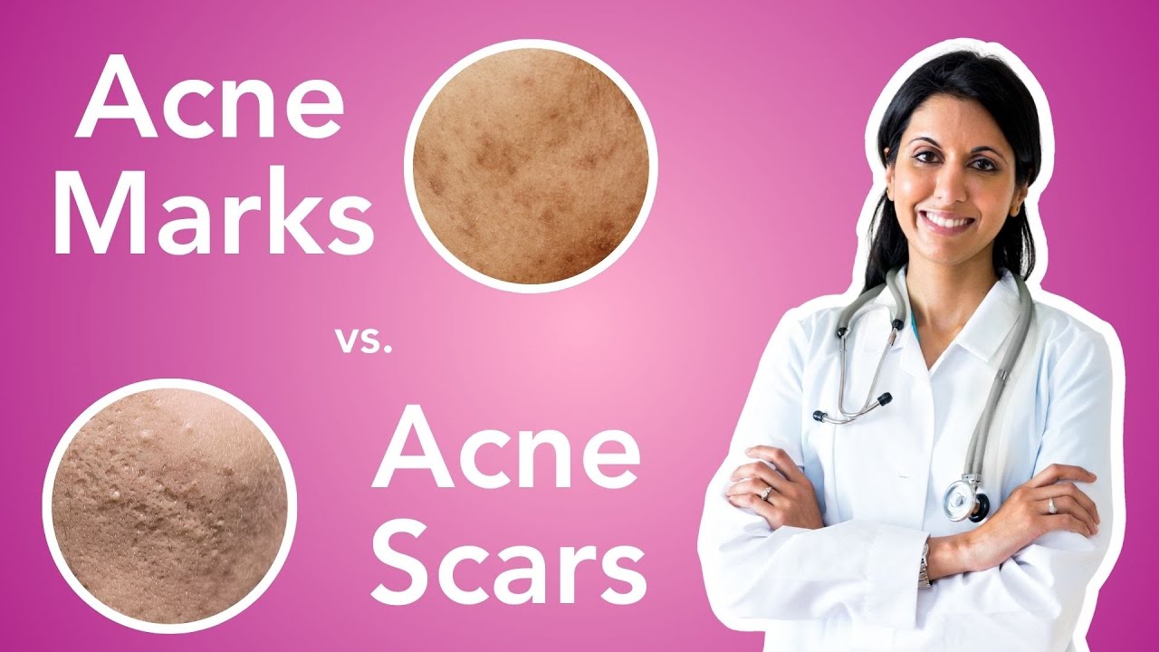 How to Treat: Acne Marks vs Acne Scars - YouTube