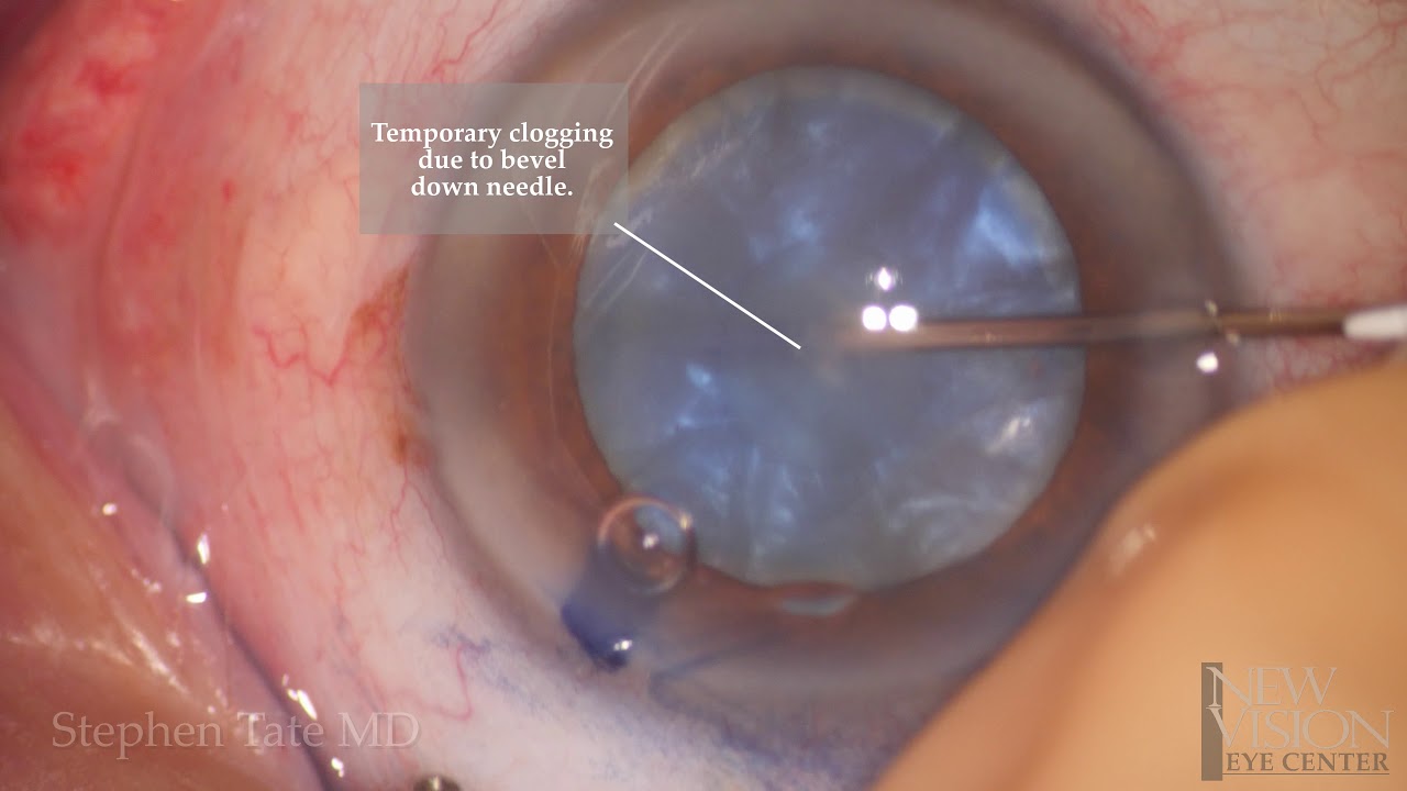 Properly Decompressing White Mature/Intumescent Cataracts with Dr ...