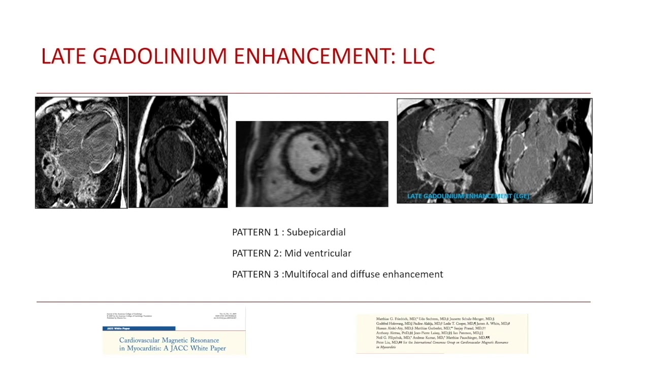 18. CMR Assessment of Myocarditis Dr Bhavna Reddy - YouTube