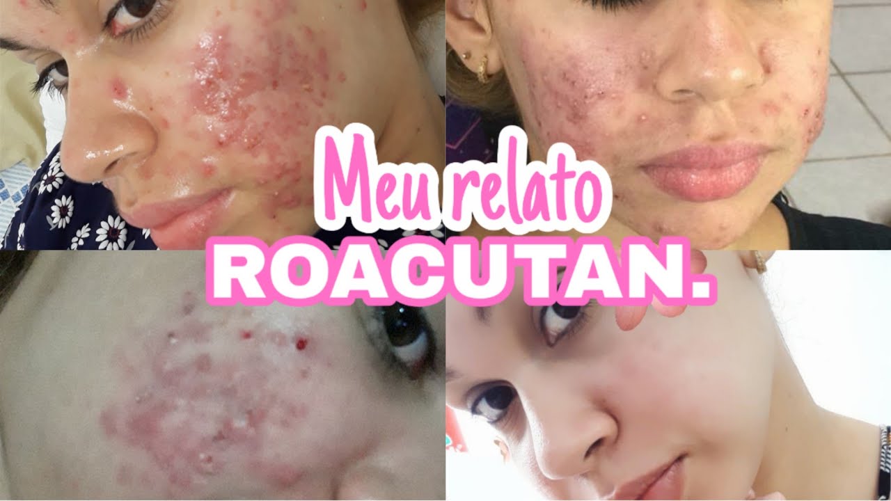 ROACUTAN: a verdade sobre ele. | MELHOREI OU PIOREI? Respondendo ...