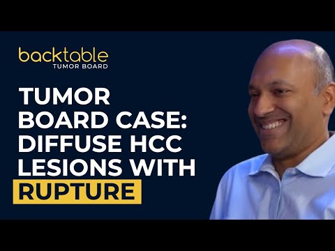 HCC Tumor Board Case 6: Diffuse HCC Lesions with Rupture - YouTube