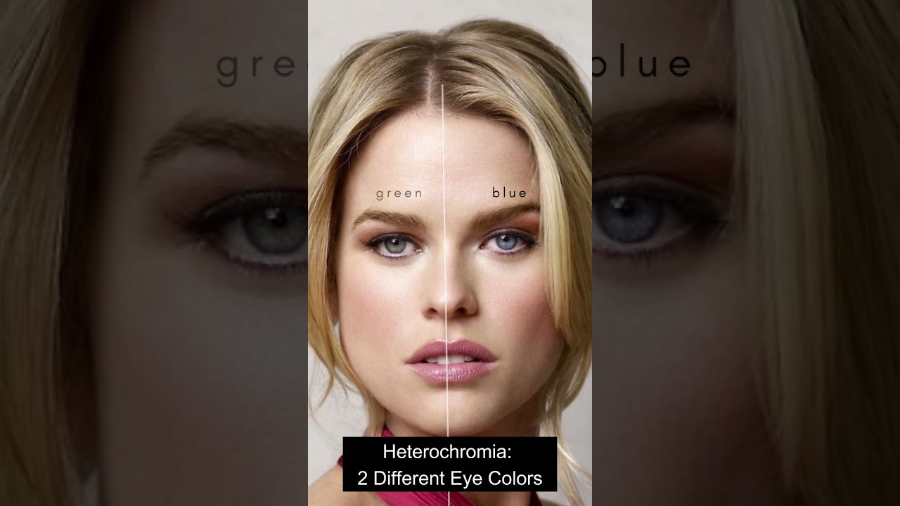 2 Different Eye Colors In One Eye