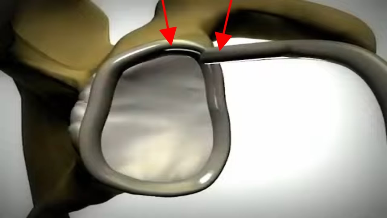 SLAP Type IV: Comprehensive Repair for Biceps-Labrum Tears SLAP 4형: 이두근 ...