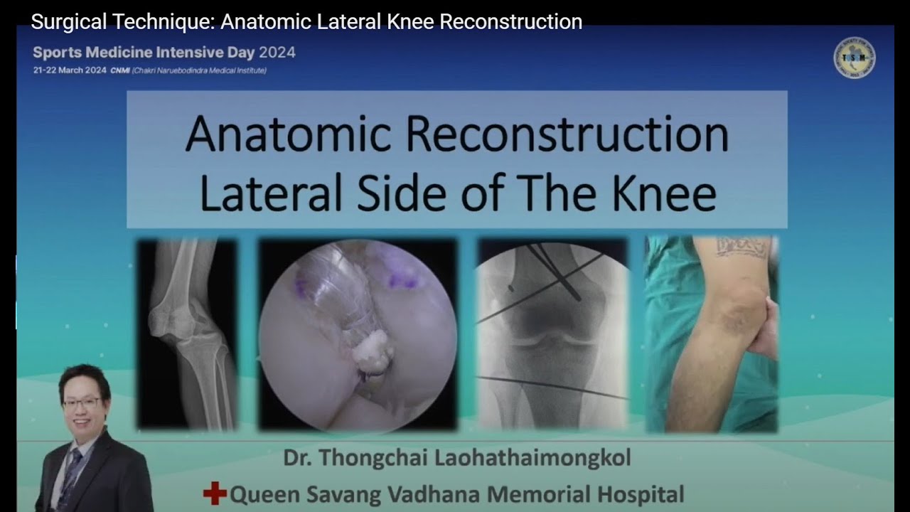 Anatomic Reconstruction Lateral Side of the Knee - YouTube