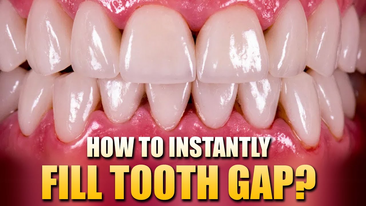 How To Instantly Fill Tooth Gap? || Dentist Dr.Vijayalakshmi about ...