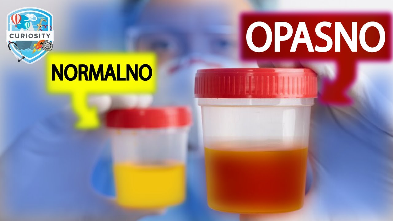 Što Boja Urina Otkriva o Vašem Zdravlju #Dr 106 - YouTube