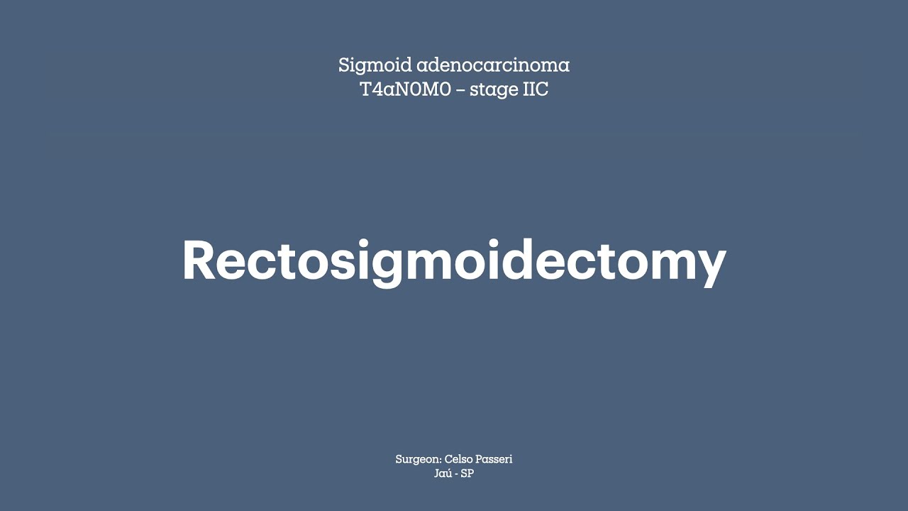 RETOSSIGMOIDECTOMIA - YouTube