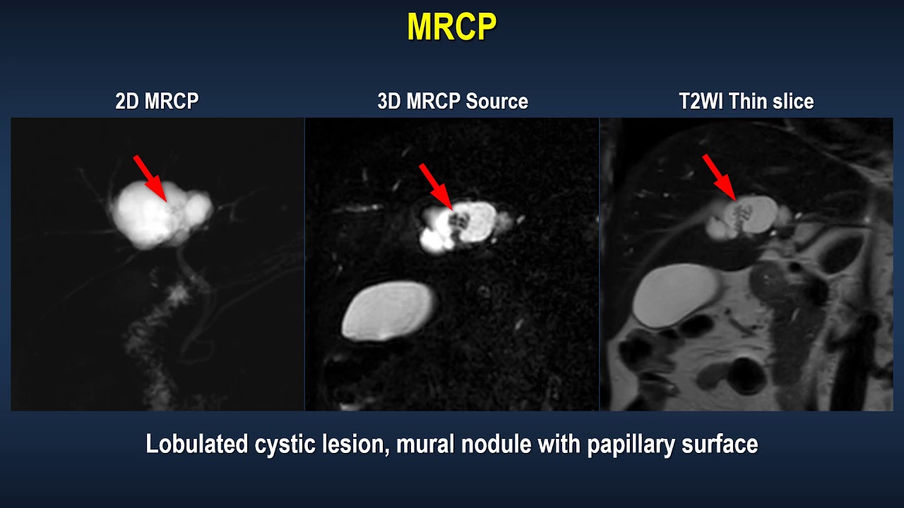 Natural course, slowly growing, cystic intraductal papillary neoplasm ...