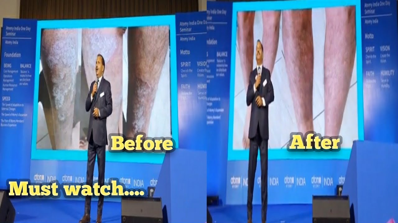 Hemohim Psoarsis Testimonal|HemoHIM Testimony|Atomy India - YouTube
