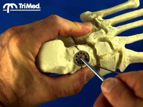 Xpode Cup Sawbone Demo - YouTube