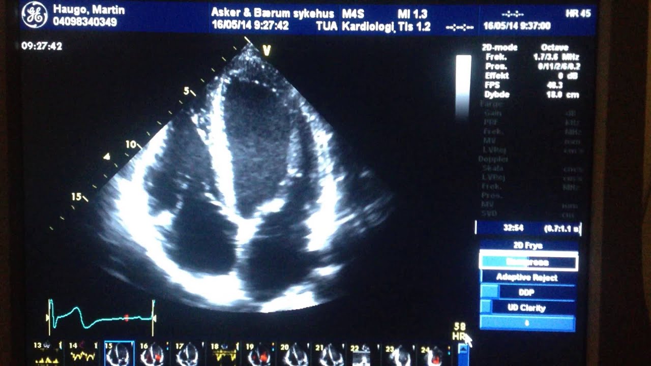 Ultralyd hjerte - YouTube