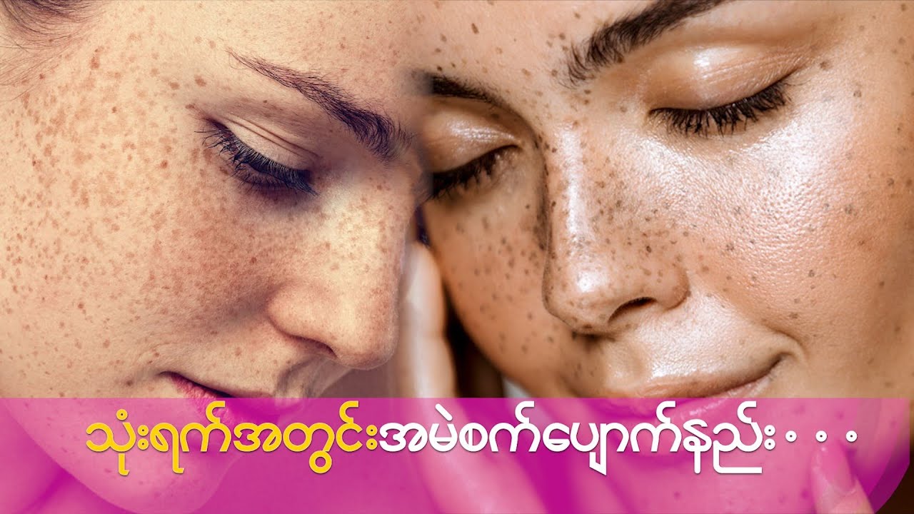 သုံးရက်အတွင်း အမဲစက်ပျောက်နည်း Youtube