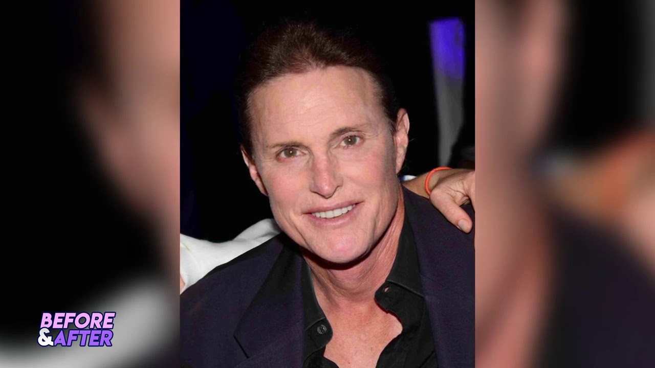 Caitlyn Jenner Before and After Transformations Plastic Surgery Bruce ...