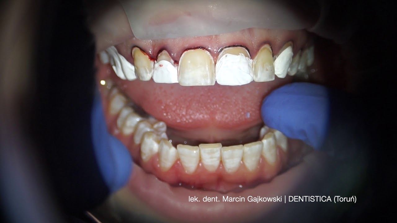 Flow injection technique - lek.dent. M.Gajkowski Dentistica Toruń - YouTube