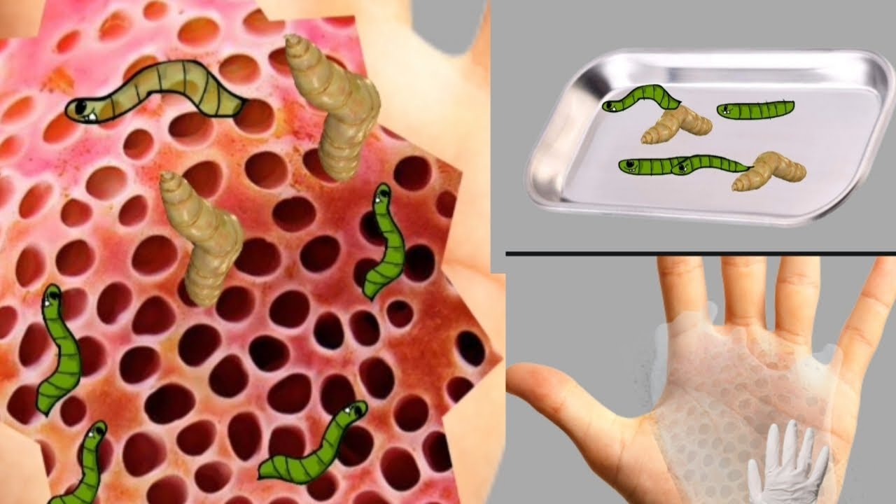 ASMR / Remove parasites from infected hand/asmr animation treatment ...