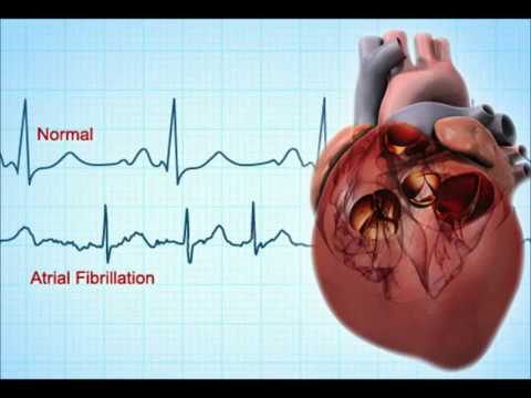 FIBRILLAZIONE ATRIALE IN 8 MINUTI Dott Giuseppe Leonardi - YouTube