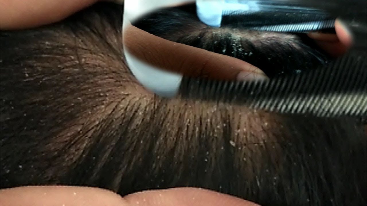 Dandruff/Extreme Dandruff Scratching / Extreme Flakes / Removing Big ...