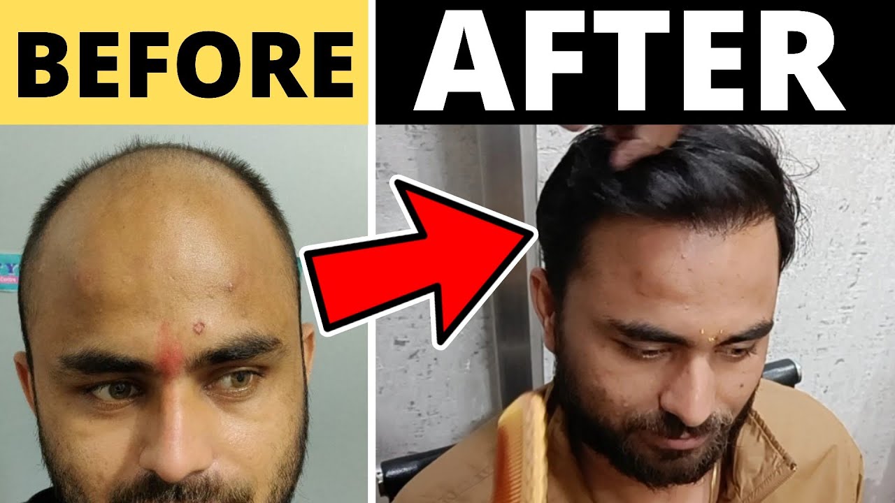 Best Hair Transplant Result After 1 Year | Best Hair Transplant In ...