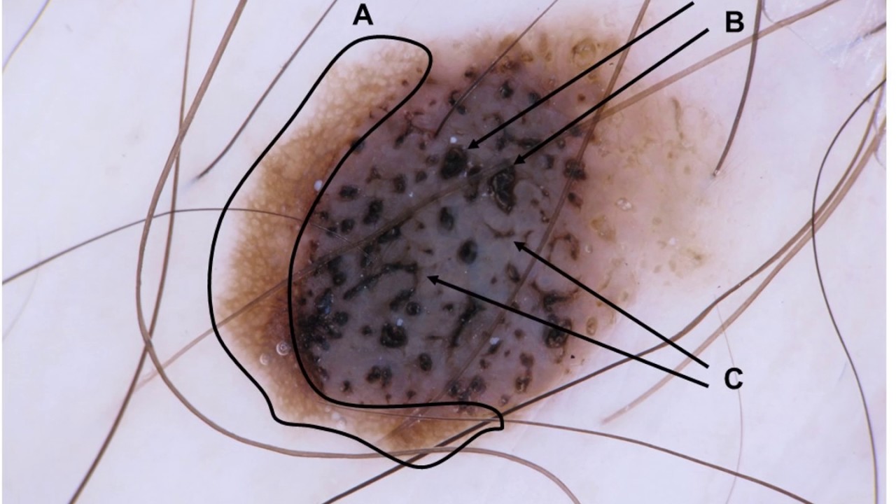 Collision lesions- Dr. Andreas Blum - YouTube