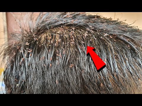 What's So Interesting About Giant lice combing - Big Lice Removal - YouTube