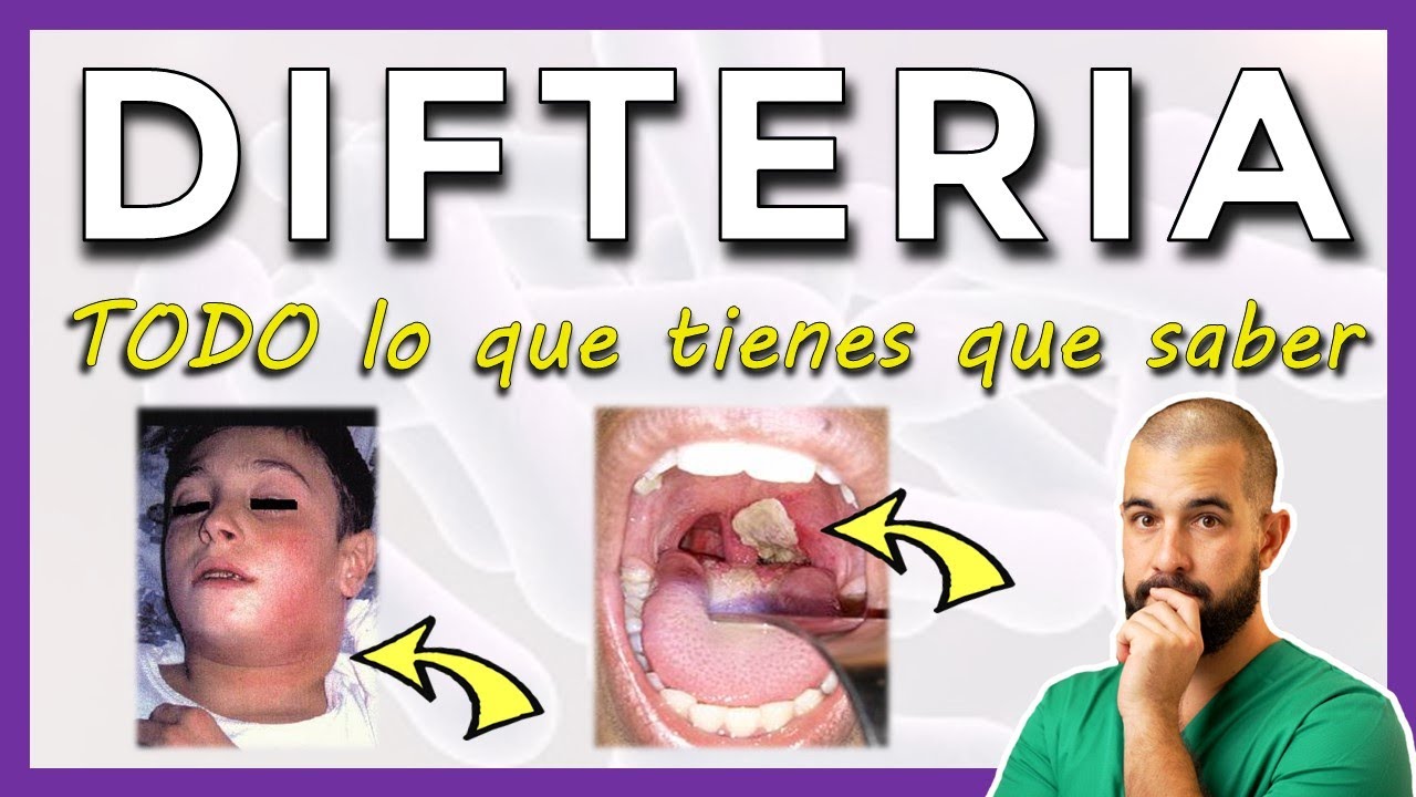 DIFTERIA - Corynebacterium diphtheriae - ¿Qué es? Contagio Síntomas ...