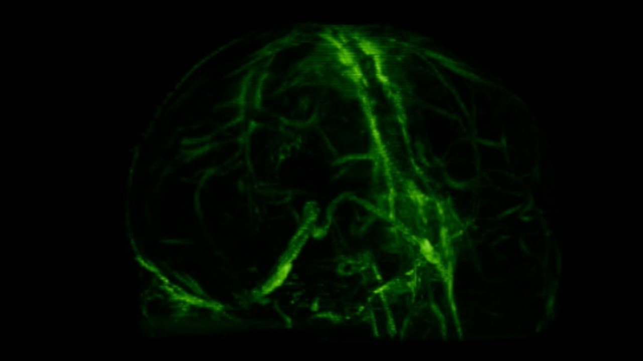 A Brain Drainage System - YouTube