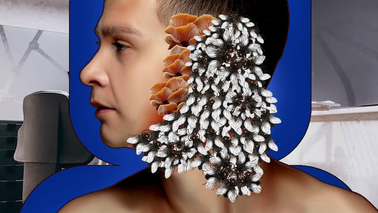 ASMR Face Treatment | ASMR Removal Botfly Maggots infected Face | ASMR ...