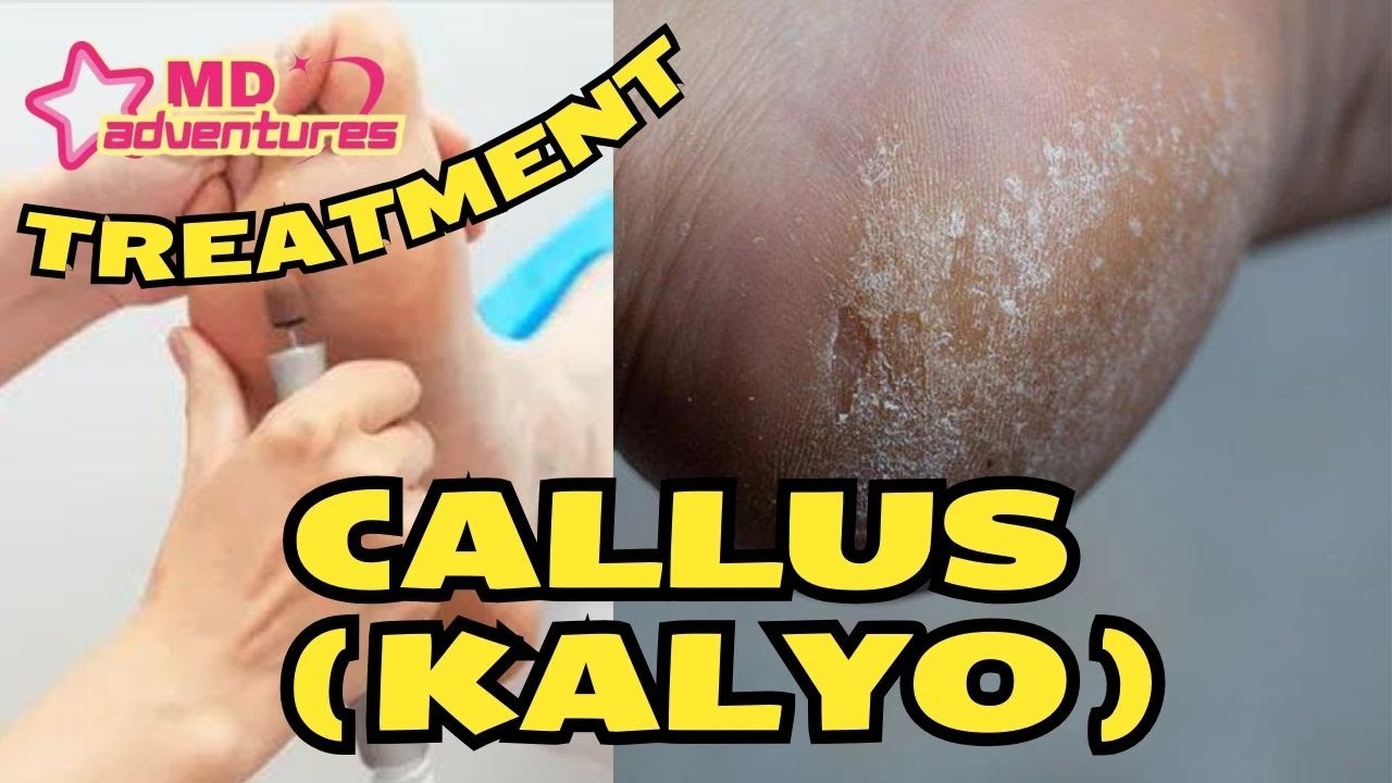 Removing Callus (Kalyo) - YouTube
