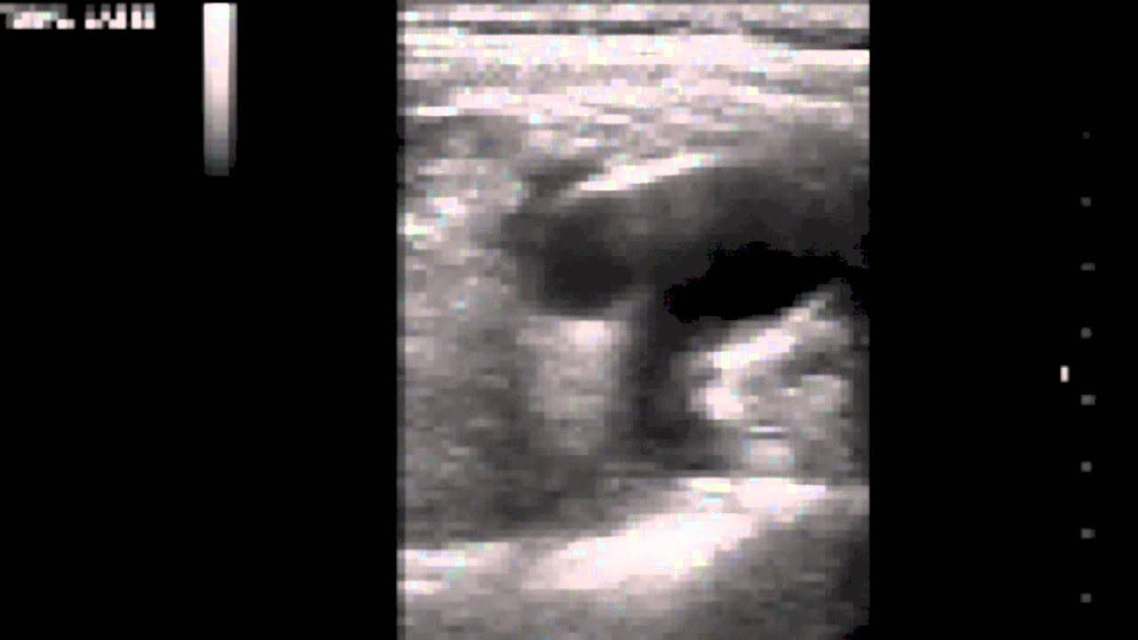 CCSVI nella Sclerosi Multipla: ipertrofia del muscolo omoioideo - YouTube