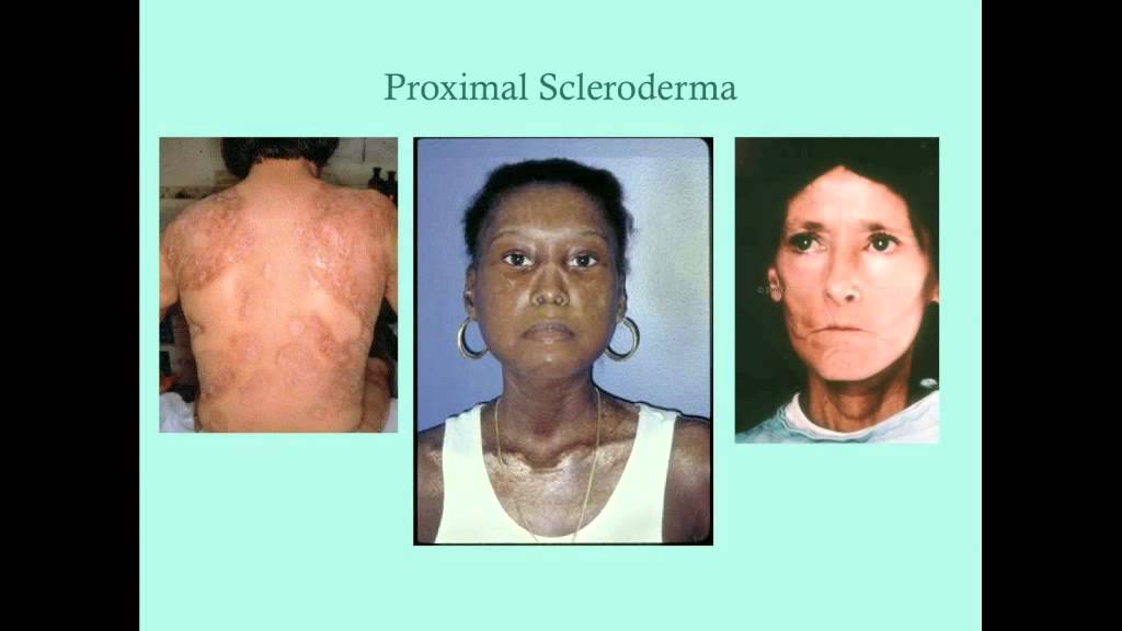 Scleroderma - CRASH! Medical Review Series - YouTube