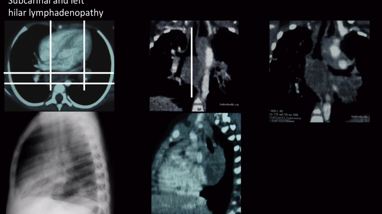 Paediatic Chest Xray Training: The lateral paediatric CXR - YouTube